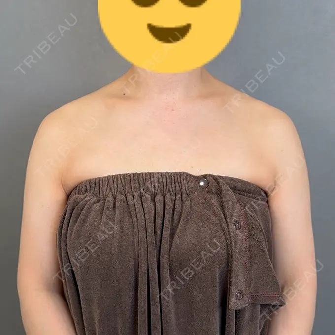 《ボトックス（肩）の口コミ》アリエル美容クリニック 大宮院のボトックス（肩）の術後経過《ユーザー名：agate_77d015》 | トリビュー