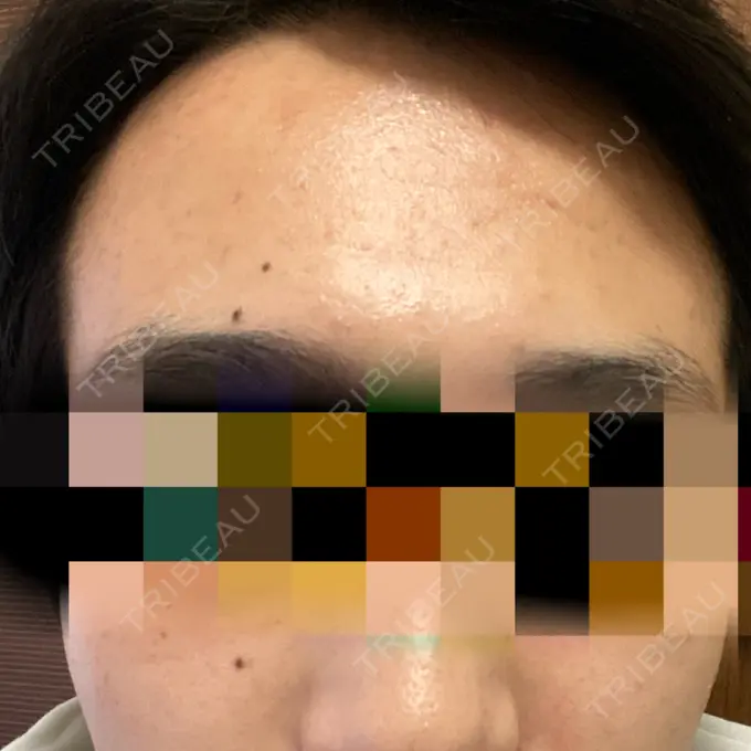 《ポテンツァの口コミ》ルラ美容クリニック 静岡院のポテンツァの術後経過《ユーザー名：onyx_765bfe》 | トリビュー