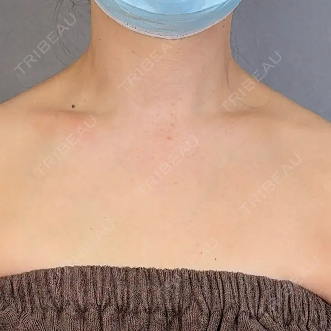 《ボトックス（肩）の口コミ》アリエル美容クリニック 大宮院のボトックス（肩）の術後経過《ユーザー名：agate_77d015》 | トリビュー