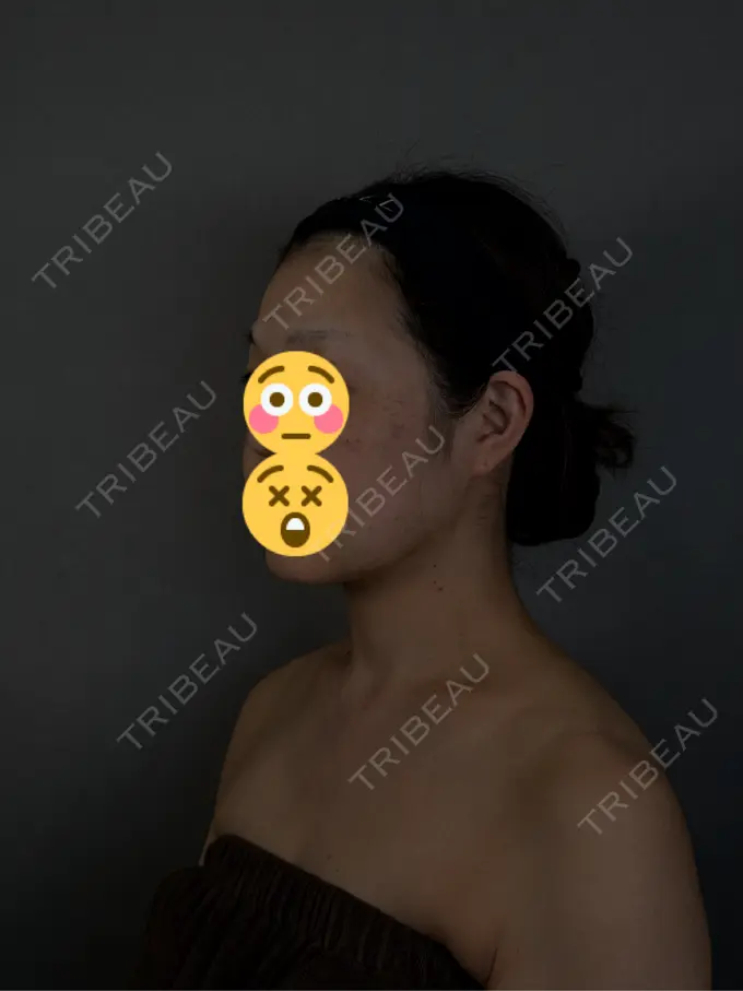 《ボトックス（肩）の口コミ》アリエル美容クリニック 大宮院のボトックス（肩）の術後経過《ユーザー名：agate_77d015》 | トリビュー